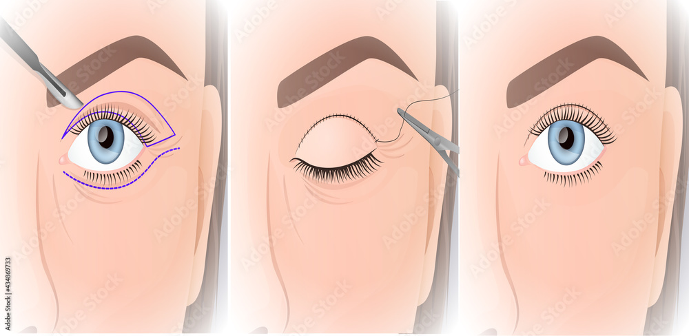 blepharoplasty procedure, plastic surgery of the upper eyelid Stock ...