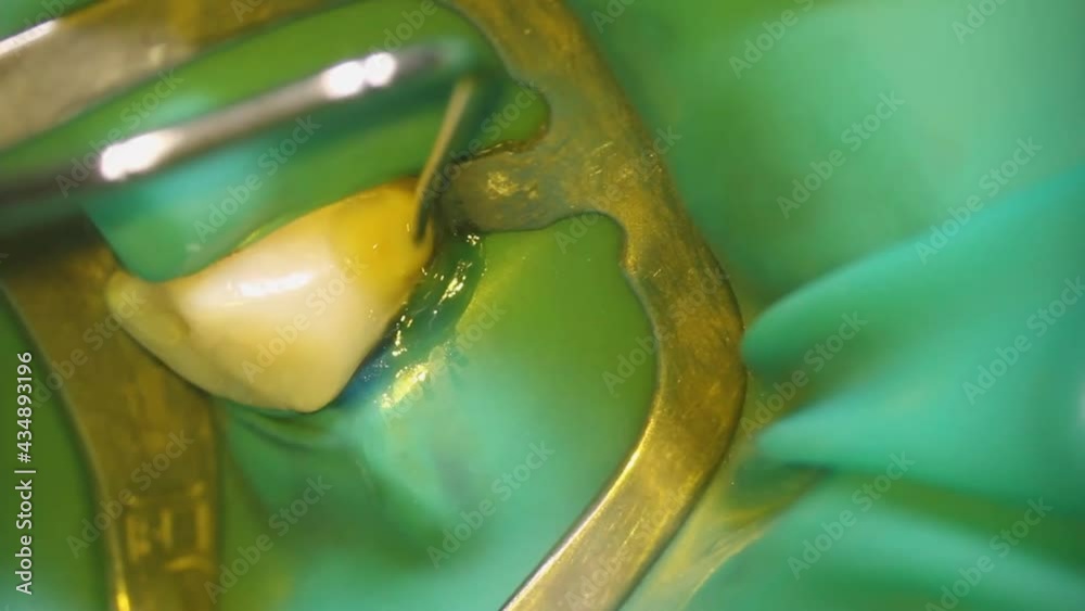 dentistry. shooting with a microscope. dental treatment. alignment with ...