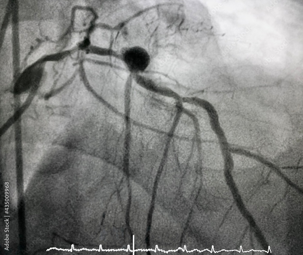Coronary angiogram shown left anterior descending artery (LAD) stenosis ...