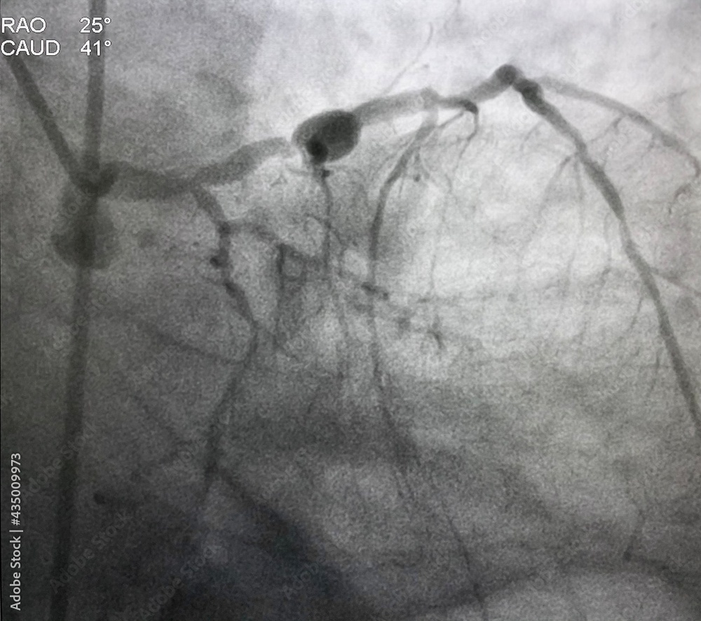Coronary angiogram shown left anterior descending artery (LAD) stenosis ...