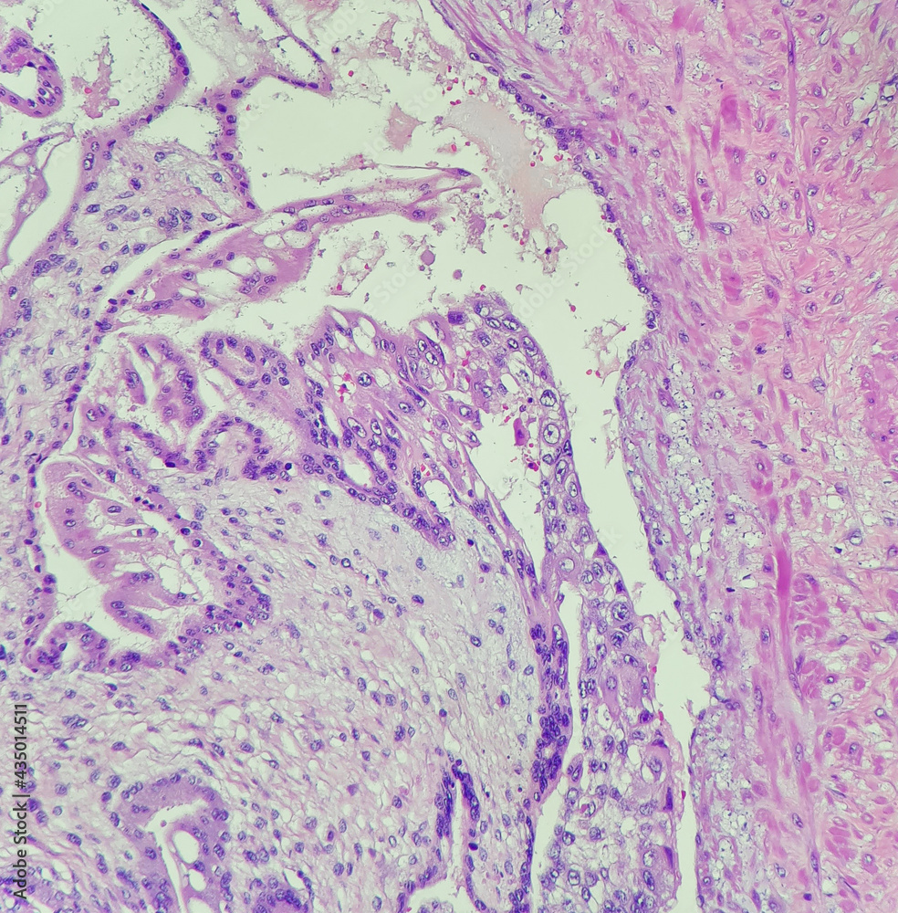 Photo of invasive hydatidiform mole, showing vascular invasion of ...