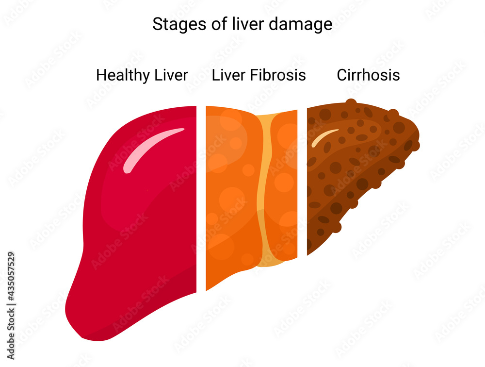 Stage of liver damage. Design for poster, infographic, presentation ...