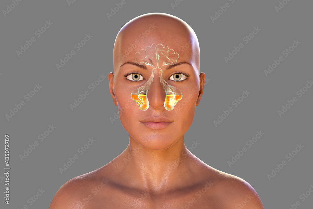 Sinusitis, inflammation of paranasal cavities. 3D illustration showing ...