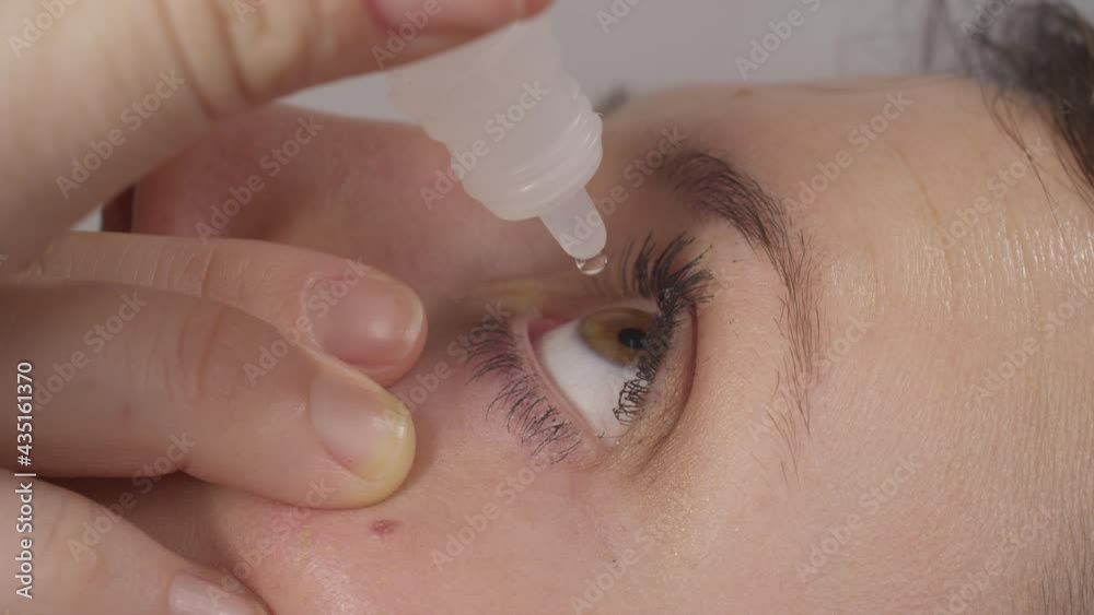 CLOSE UP: Adult Caucasian female drops eye medicine into her dry left ...