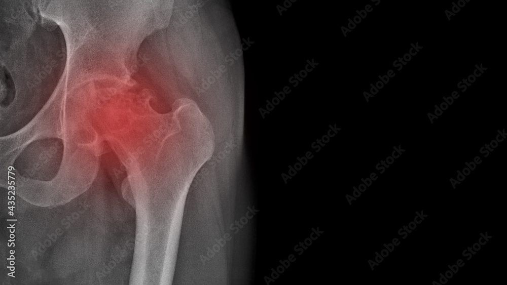 X-ray of a painful hip in a man with osteoarthritis of the left hip ...