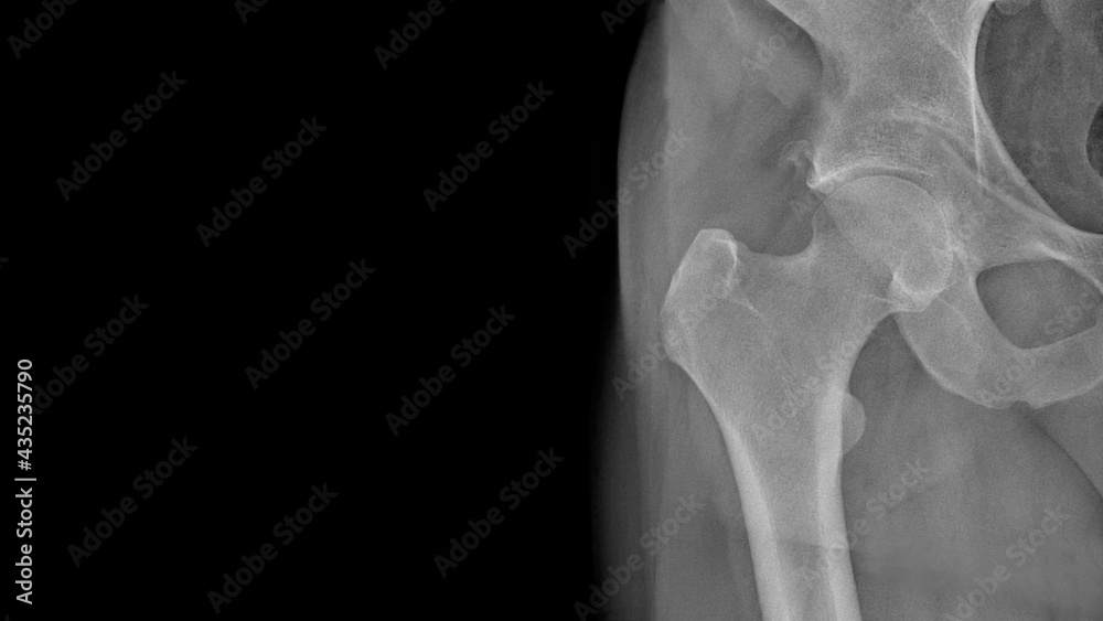 X-ray of a healthy hip in a man's left hip joint in the green area ...