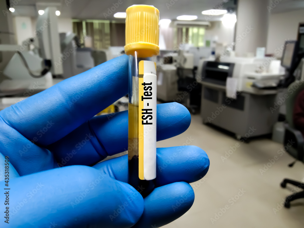 Test tube with blood sample for follicle stimulating hormone (FSH) test ...