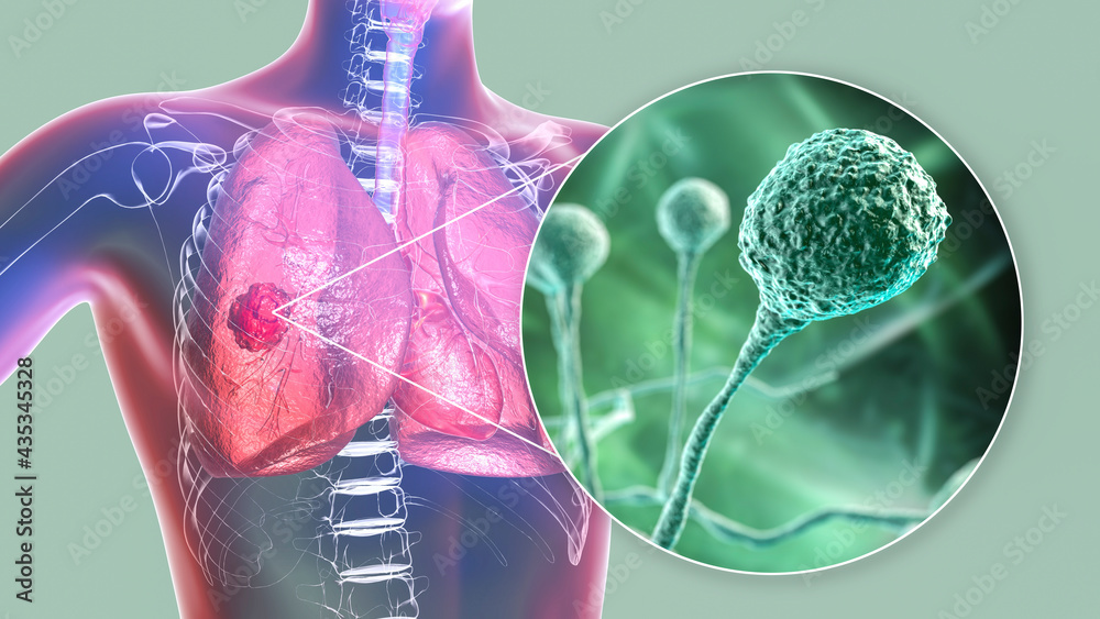 Lung mucormycosis, a lung disease caused by fungi Mucor, also known as ...