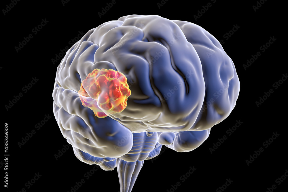 Brain mucormycosis, a brain lesion caused by fungi Mucor, also known as ...