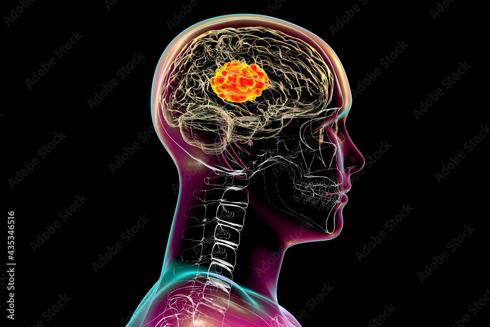 Brain mucormycosis, a brain lesion caused by fungi Mucor, also known as ...
