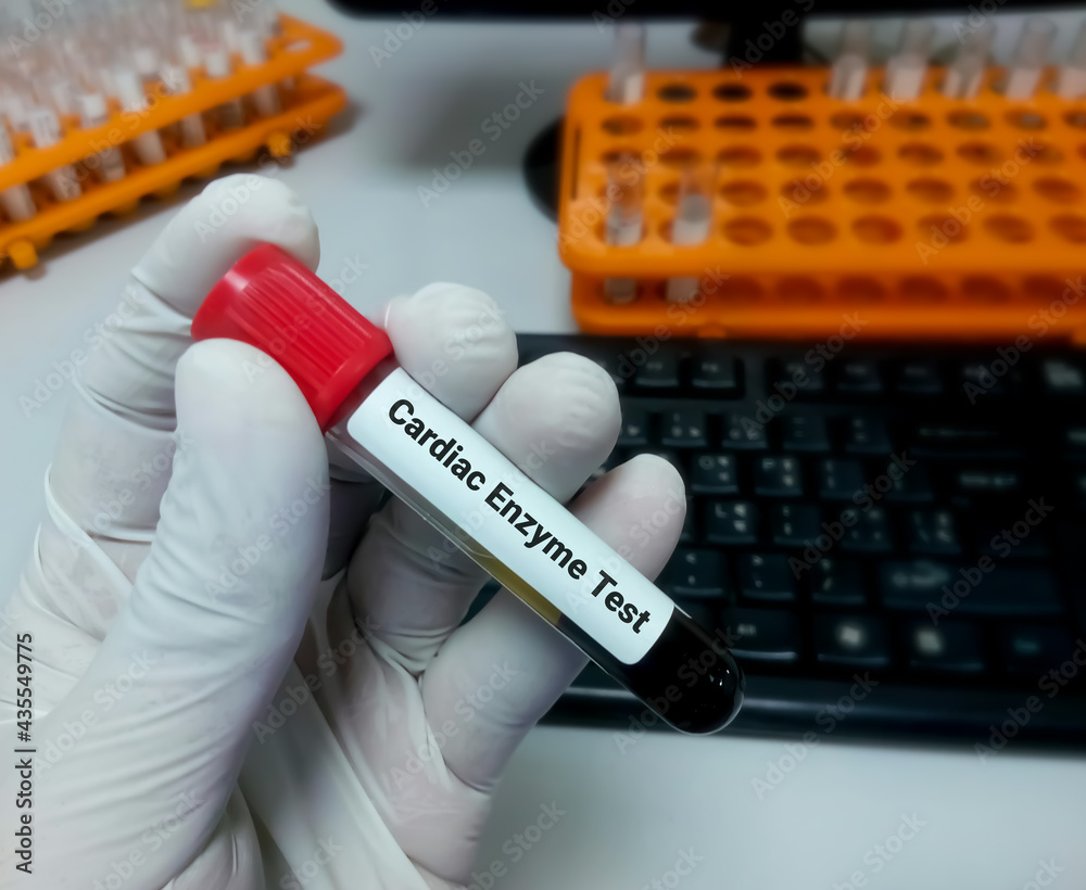Blood sample for cardiac enzyme test, myocardial infarction (MI) Stock ...