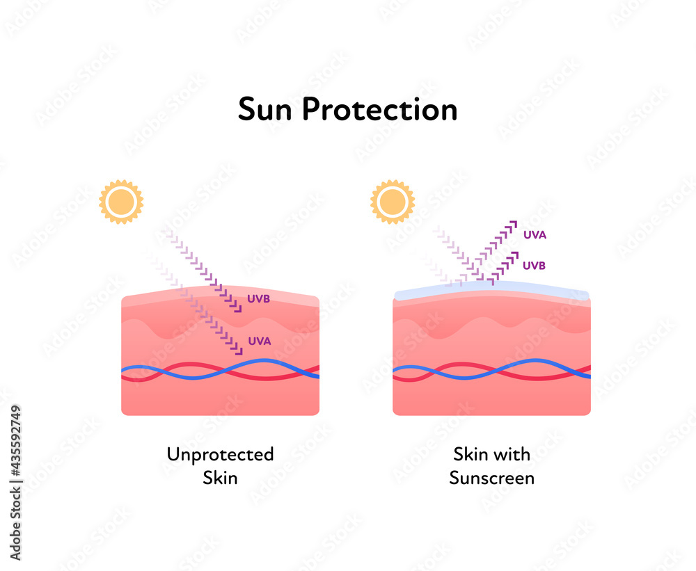 Sun protection medical infographic. Vector flat illustration. Skin ...