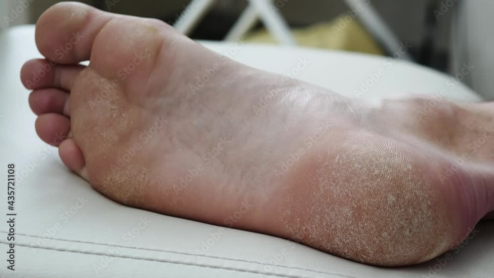 Human foot. Dry skin, Psoriasis of the feet. The skin is damaged ...