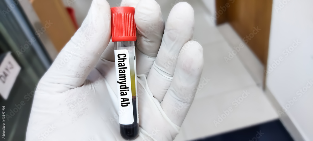 Blood sample tube with sample for Chlamydia Ab test Stock Photo | Adobe ...