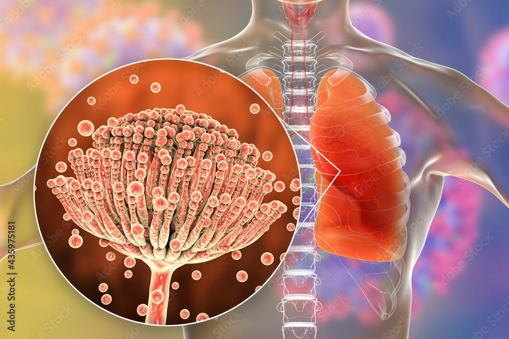 Pulmonary aspergillosis, invasion of a lung tissue by mold fungi ...