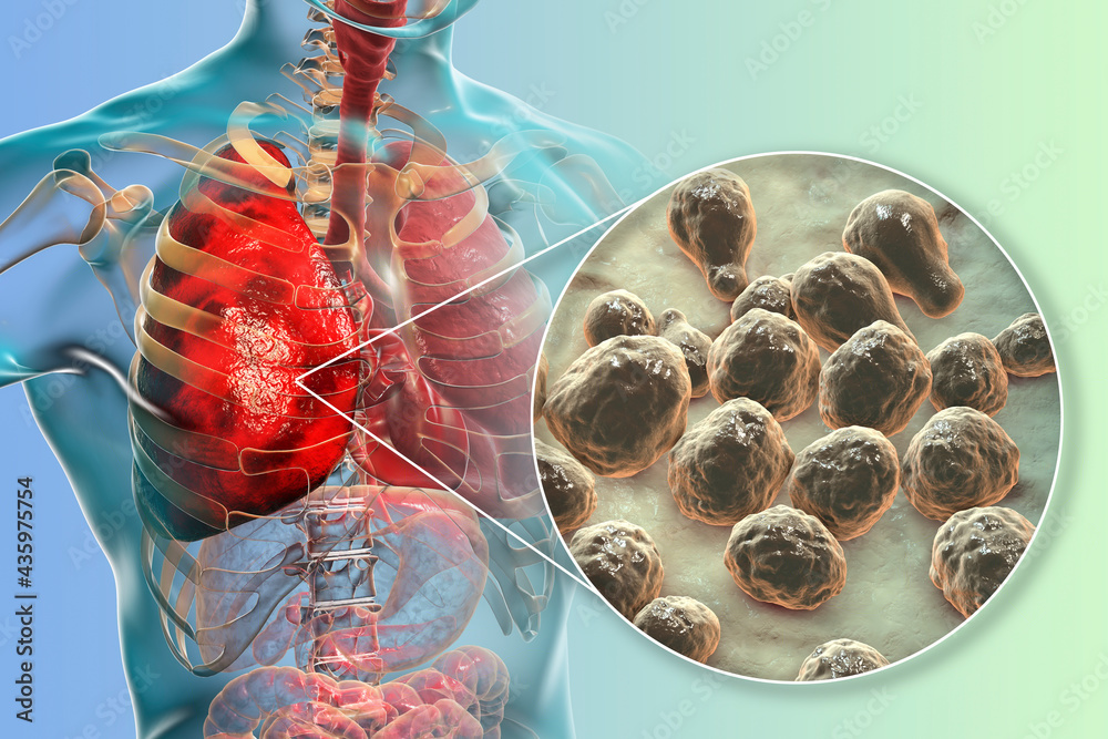 Pulmonary cryptococcosis, invasion of a lung tissue by yeast fungi ...