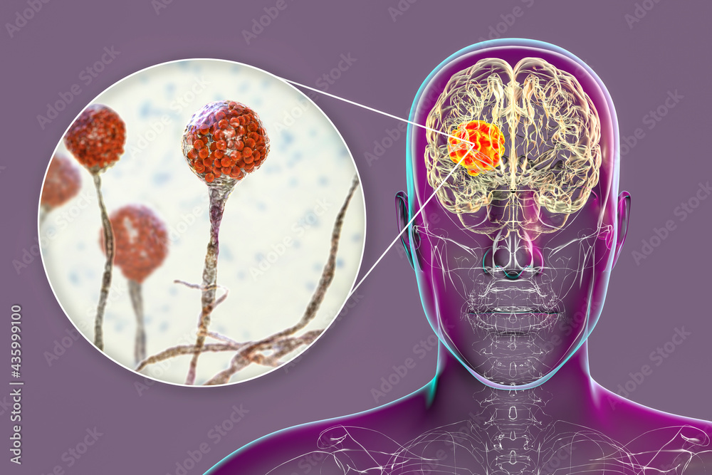 Brain mucormycosis, a brain lesion caused by fungi Mucor, also known as ...