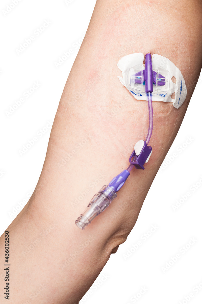 PICC line on the arm of a woman undergoing chemotherapy for breast ...