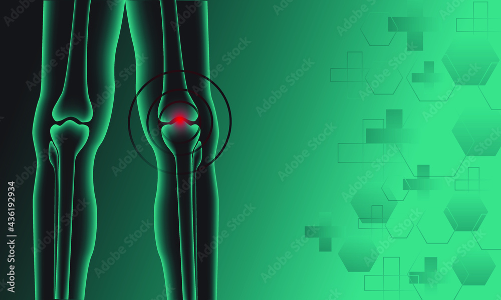Illustration of Arthritis joint . Rheumatoid arthritis. Pain in leg ...