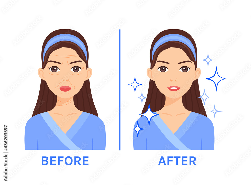 Beautiful Pretty Woman with Wrinkles on her Face. Treatment of wrinkles ...