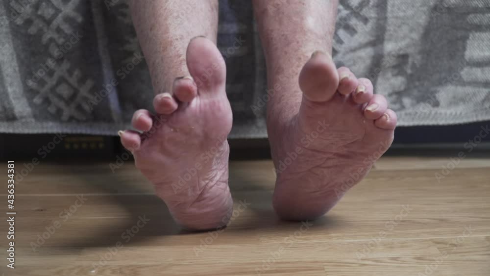 Sore toenails closeup unrecognizable person, old man. A poor woman's ...