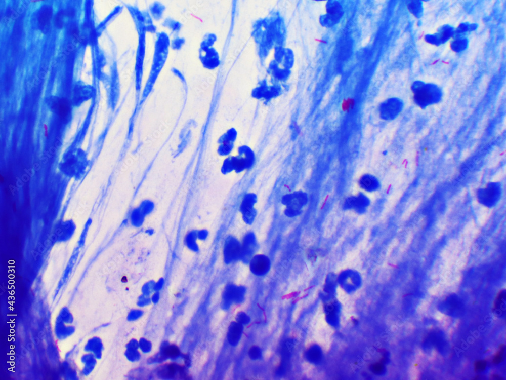 Mycobacterium tuberculosis positive (small red rod) in sputum smear ...