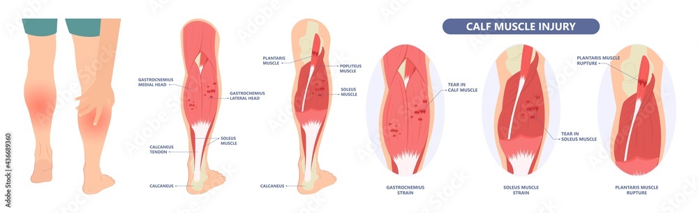 Calf Pain leg back muscle blood vessels nerve acute sport damage ...