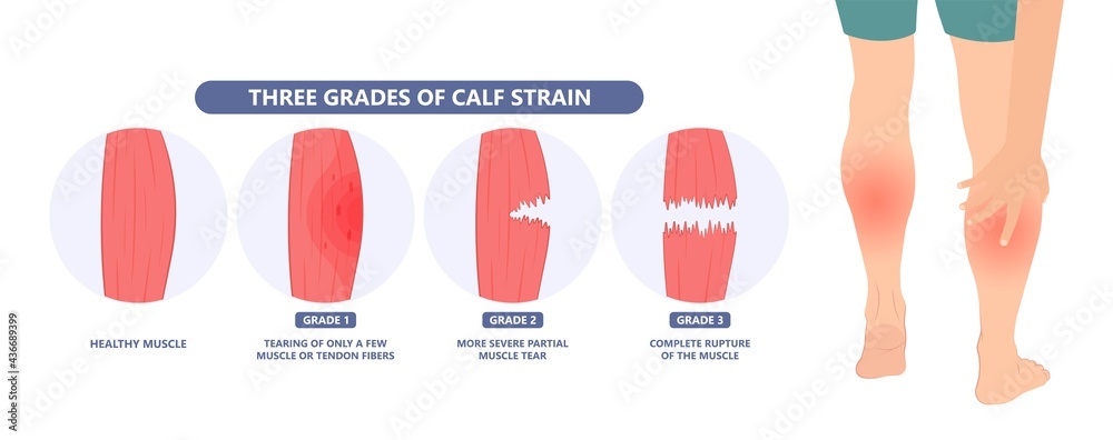 Calf Muscle Tear Bruising