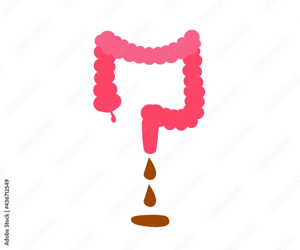 Large intestine on a white background. Diarrhea. Vector illustration ...