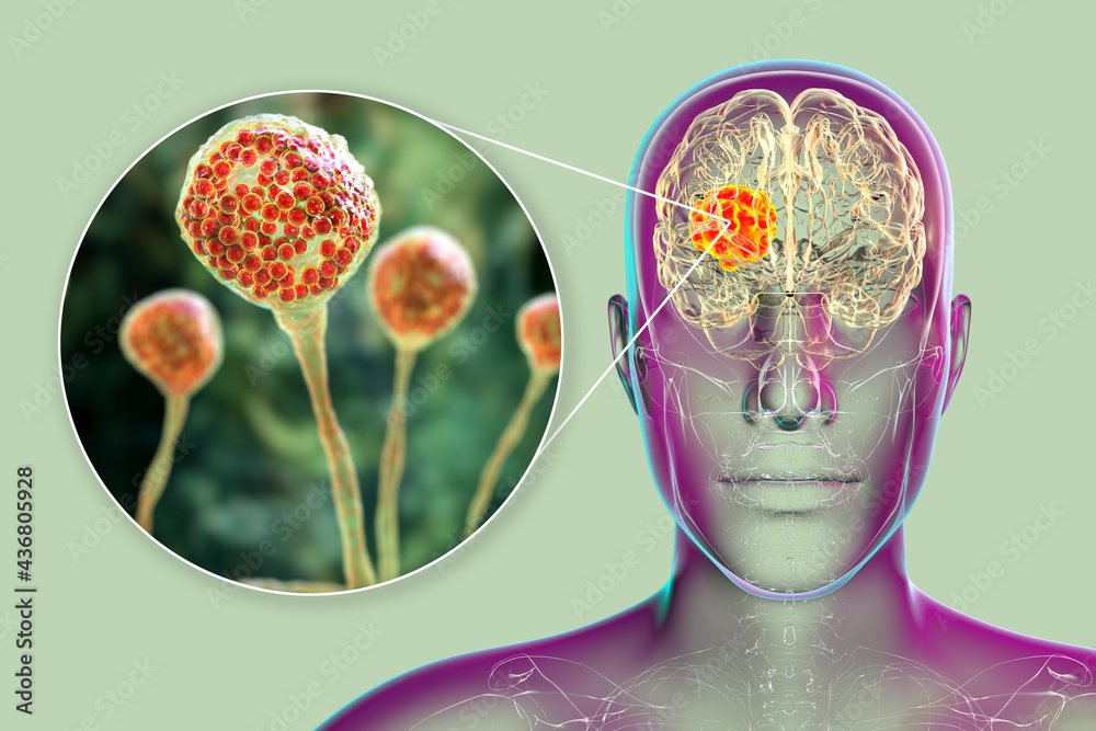 Brain mucormycosis, a brain lesion caused by fungi Mucor, also known as ...