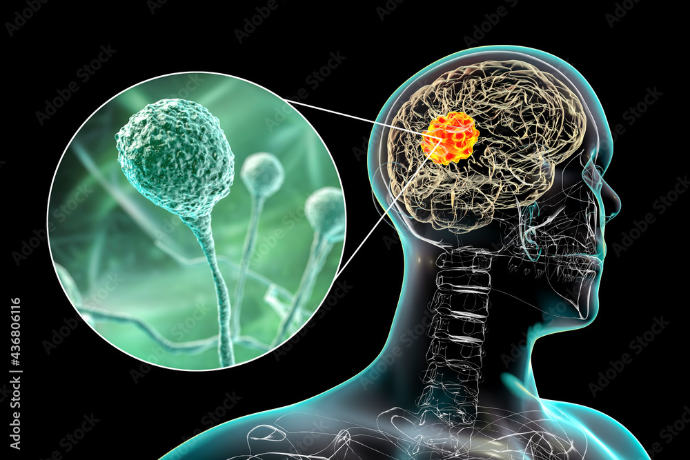 Brain mucormycosis, a brain lesion caused by fungi Mucor, also known as ...