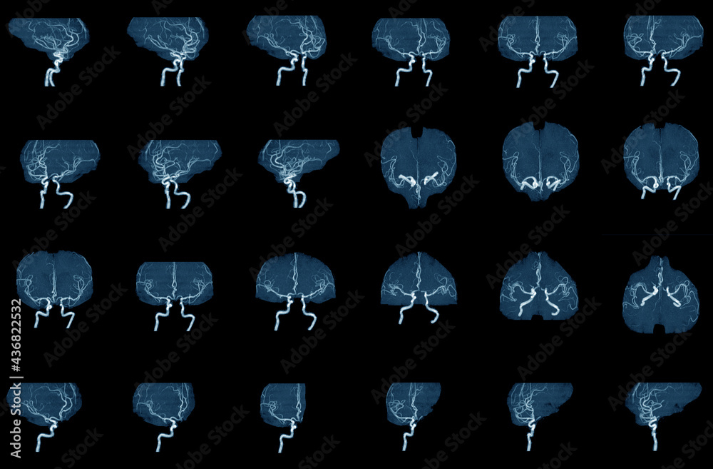 MRA and MRI image of blood vessels in brain for a medical diagnosis ...