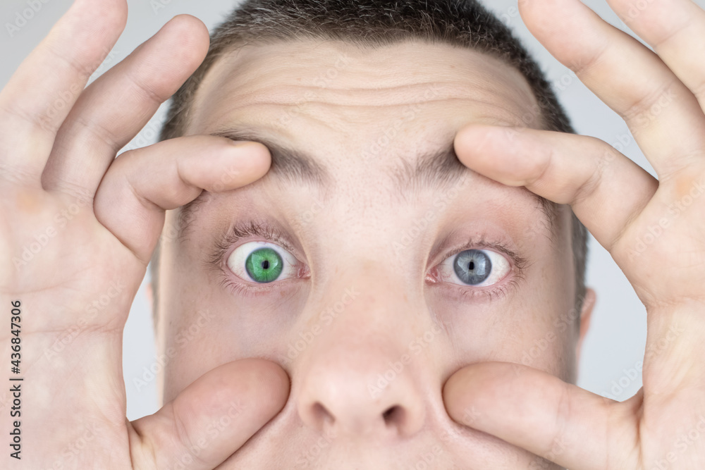 A man with different color eyes looks into the frame. The right eye is ...