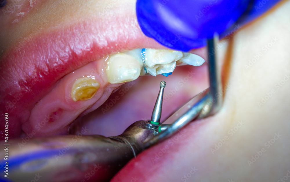 Treatment of baby teeth in a child, dental drill, installation and ...