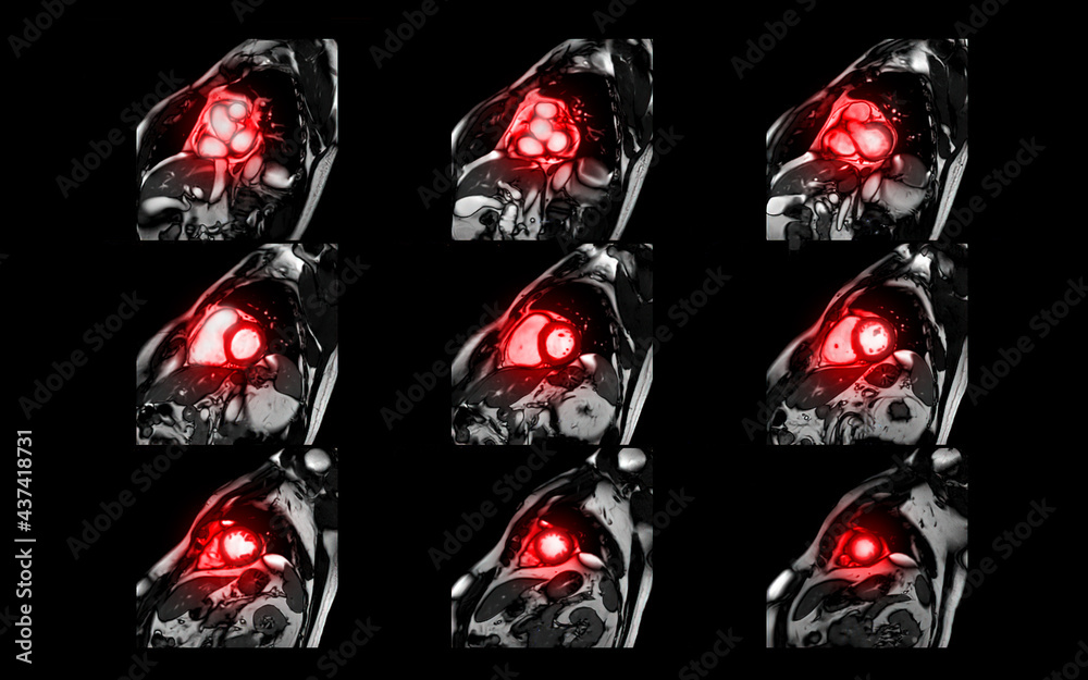 MRI heart or Cardiac MRI magnetic resonance imaging of heart in short ...
