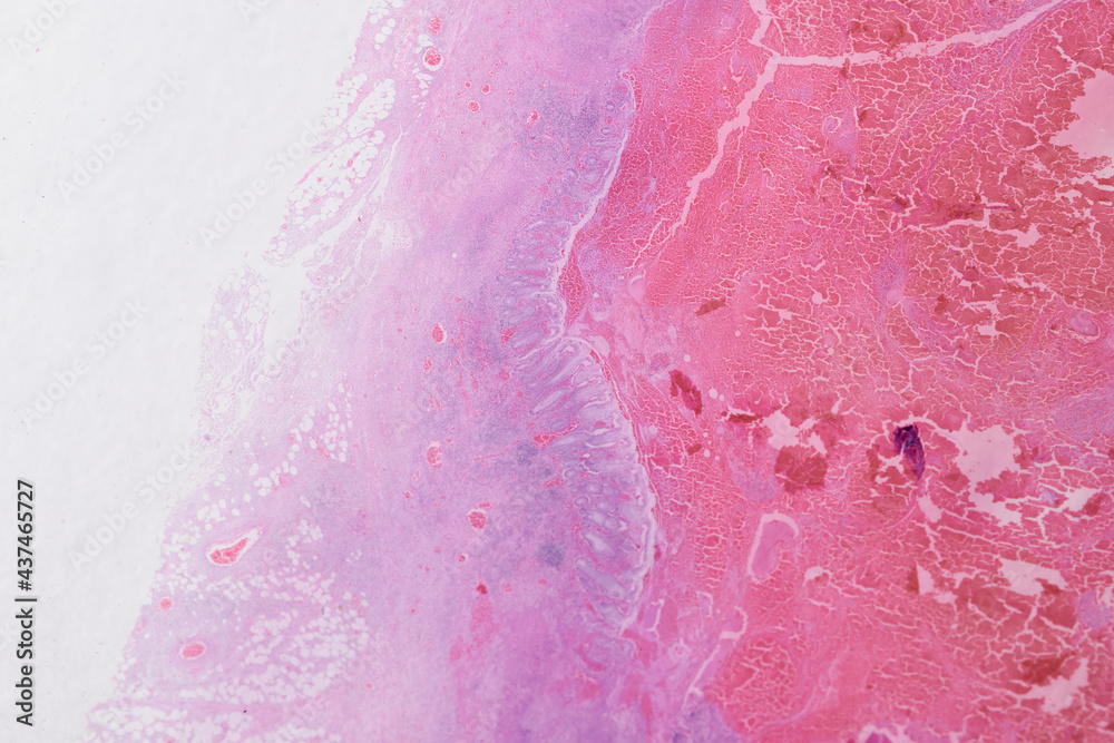 Appendix cells histopathology slide of human biopsy. Oncology, biology ...