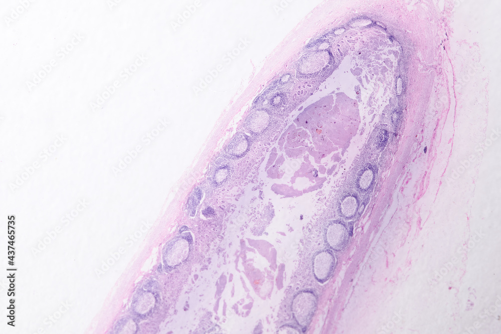 Appendix cells histopathology slide of human biopsy. Medical care ...