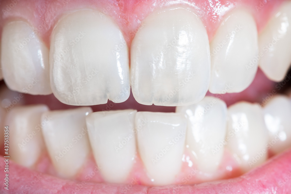 Concept of microfractures on the dental surface. Slight superficial ...