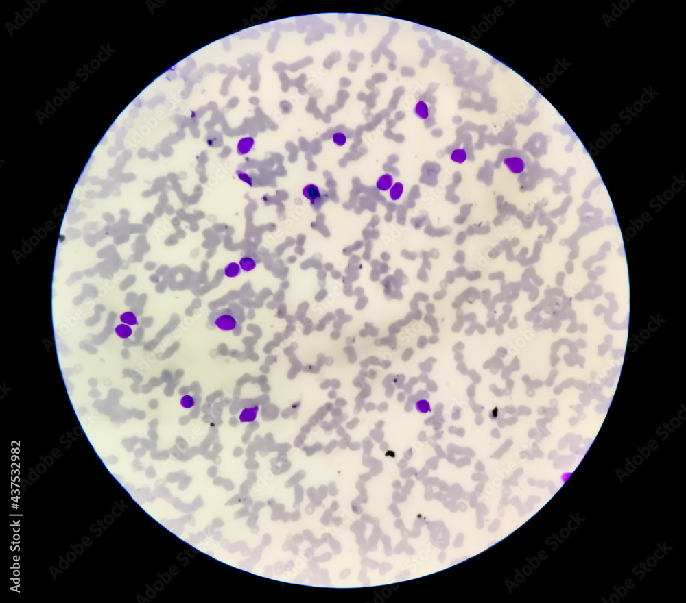Blood smear under microscopy showing on Adult acute myeloid leukemia ...