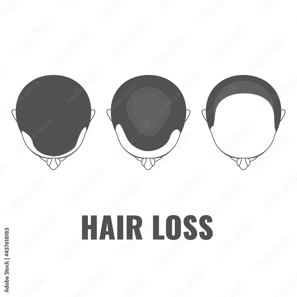 Male pattern hair loss set. Stages of baldness in men. Androgenetic ...