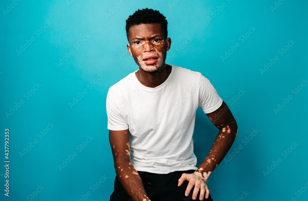 Portrait of a Black man with vitiligo Stock Photo | Adobe Stock