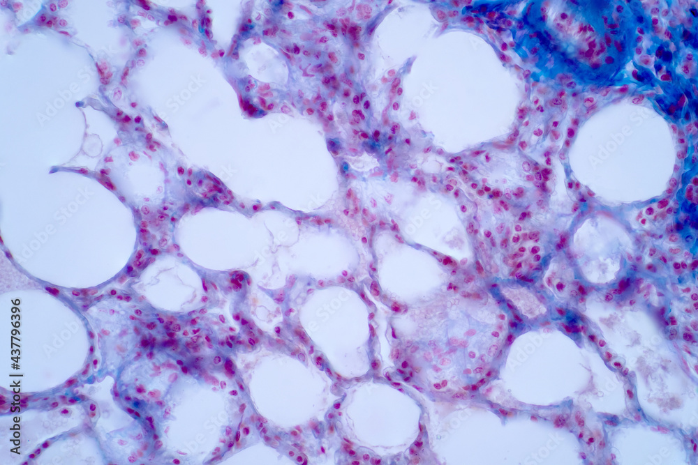 Human lung pathology under light microscope. Stock Photo | Adobe Stock