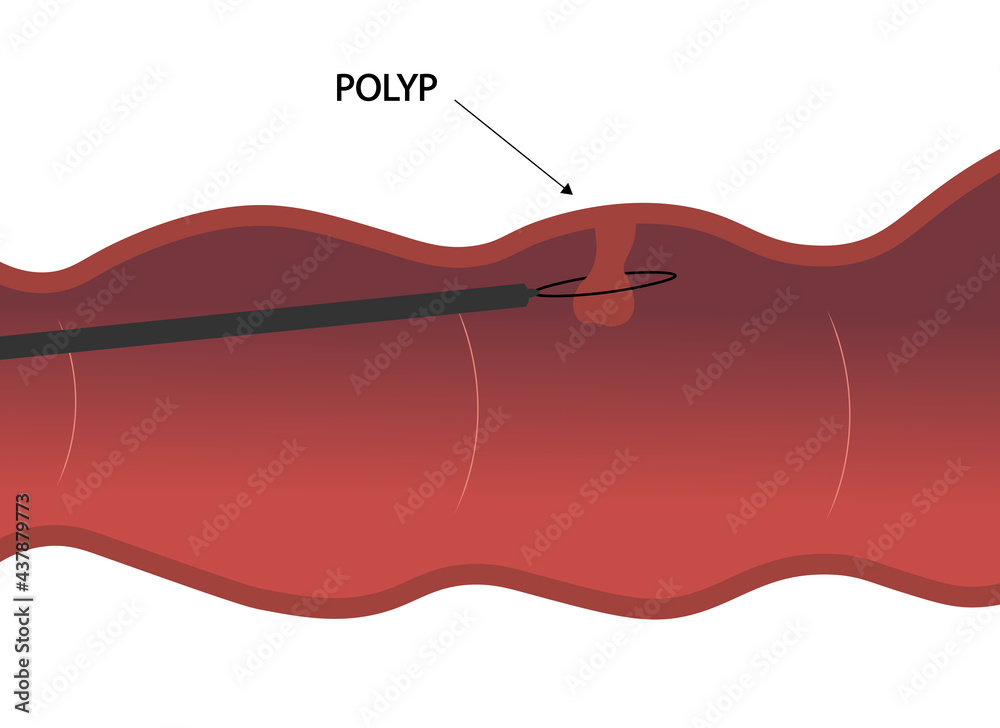 Colon polyp. Colon polypectomy illustration. Stock Illustration | Adobe ...