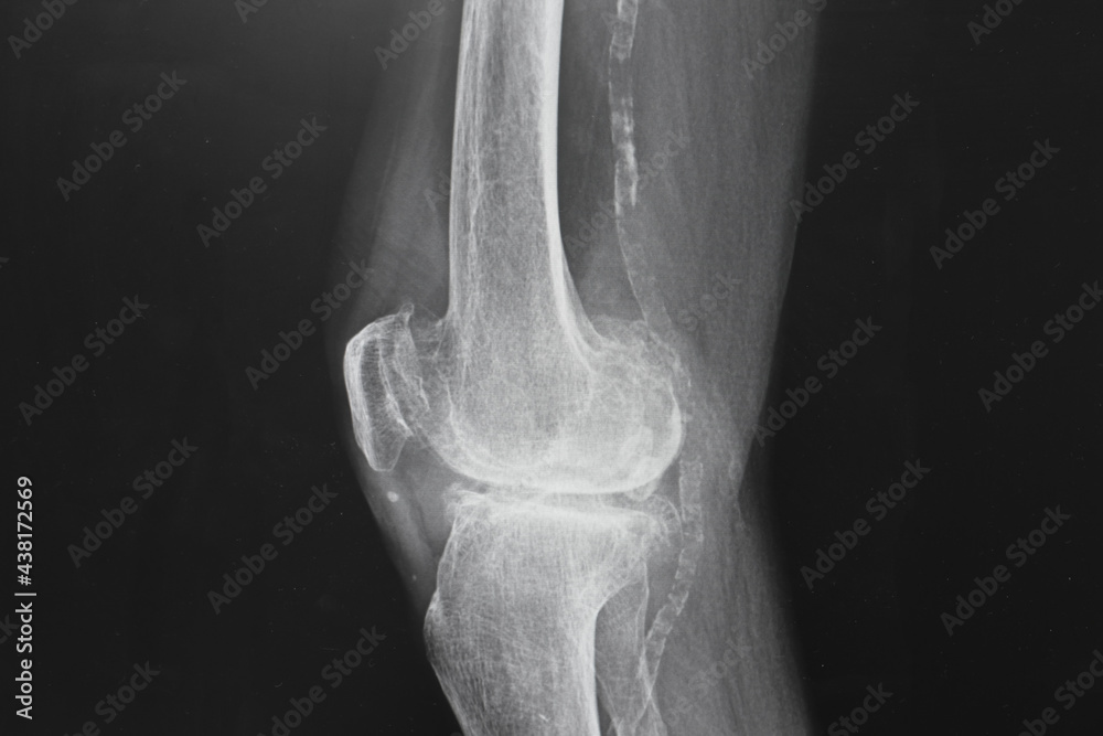 x ray image of knee. X-ray of the knee joint, x-ray shown calcific of ...