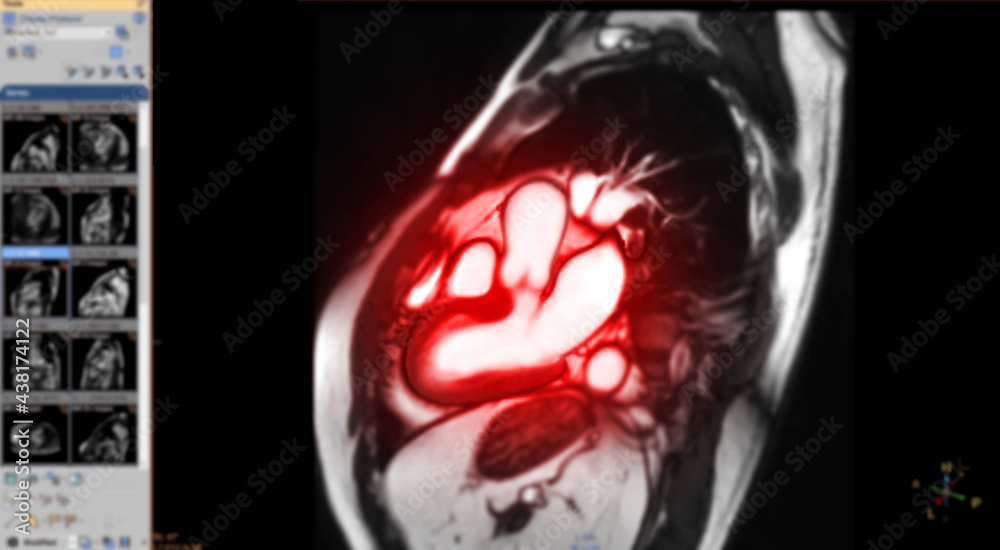 MRI heart or Cardiac MRI magnetic resonance imaging of heart in ...