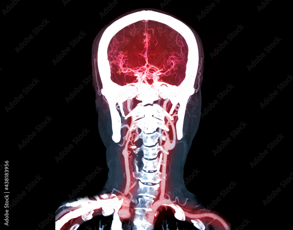 Collection of CTA brain or CT angiography of the brain comparison Mip ...