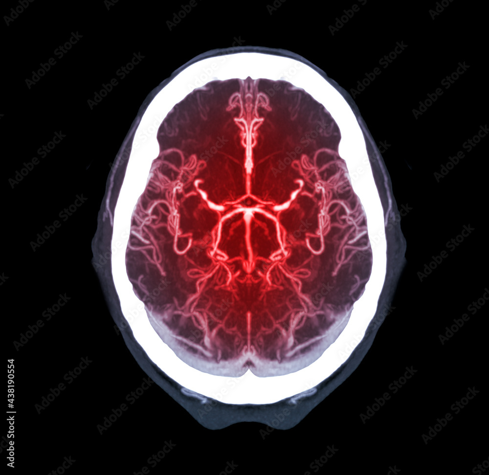 Collection of CTA brain or CT angiography of the brain comparison Mip ...