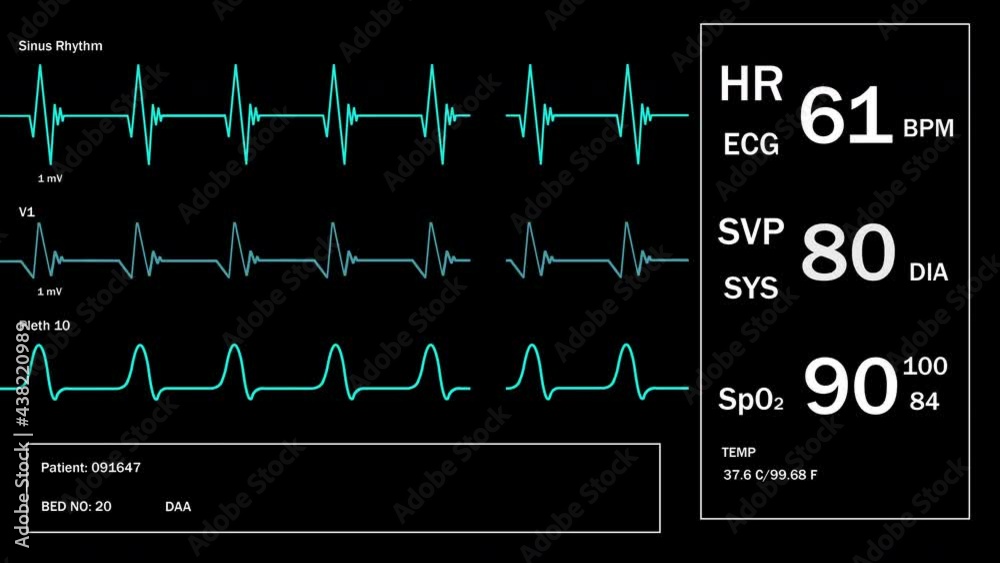 Looped: Patient monitor displays vital signs ECG electrocardiogram EKG ...