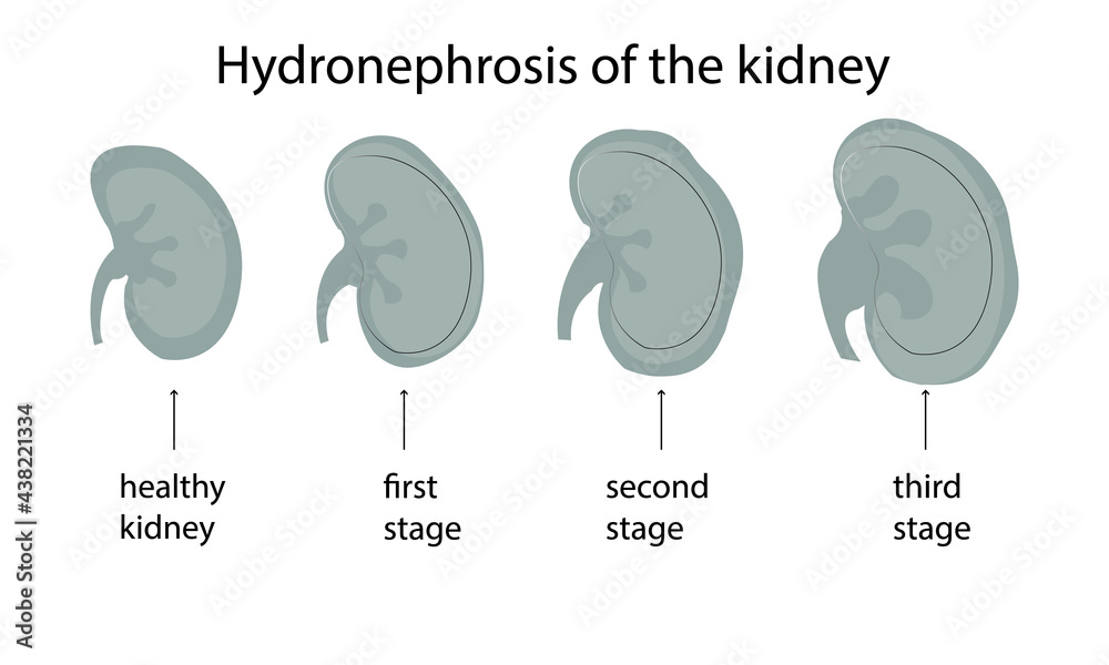 Renal hydronephrosis is a progressive,stages of the disease, persistent ...