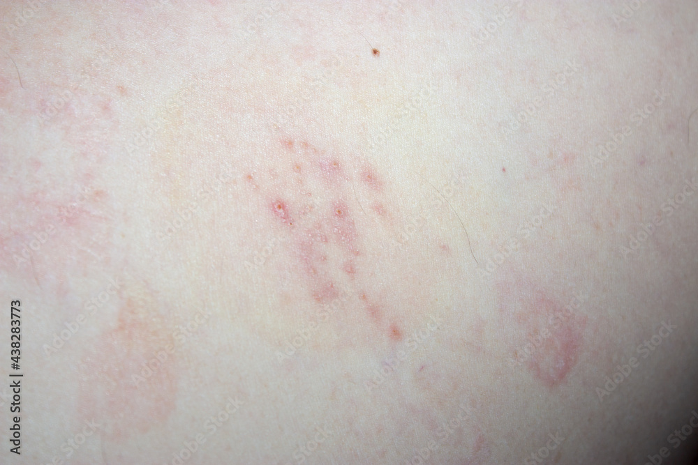 human body sore blood vessels and cuts Stock Photo | Adobe Stock